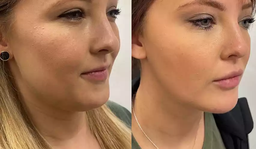 6 Benefits of QuantumRF in Columbus: Effective Skin Tightening Solutions