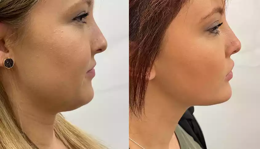 6 Benefits of QuantumRF in Columbus: Effective Skin Tightening Solutions